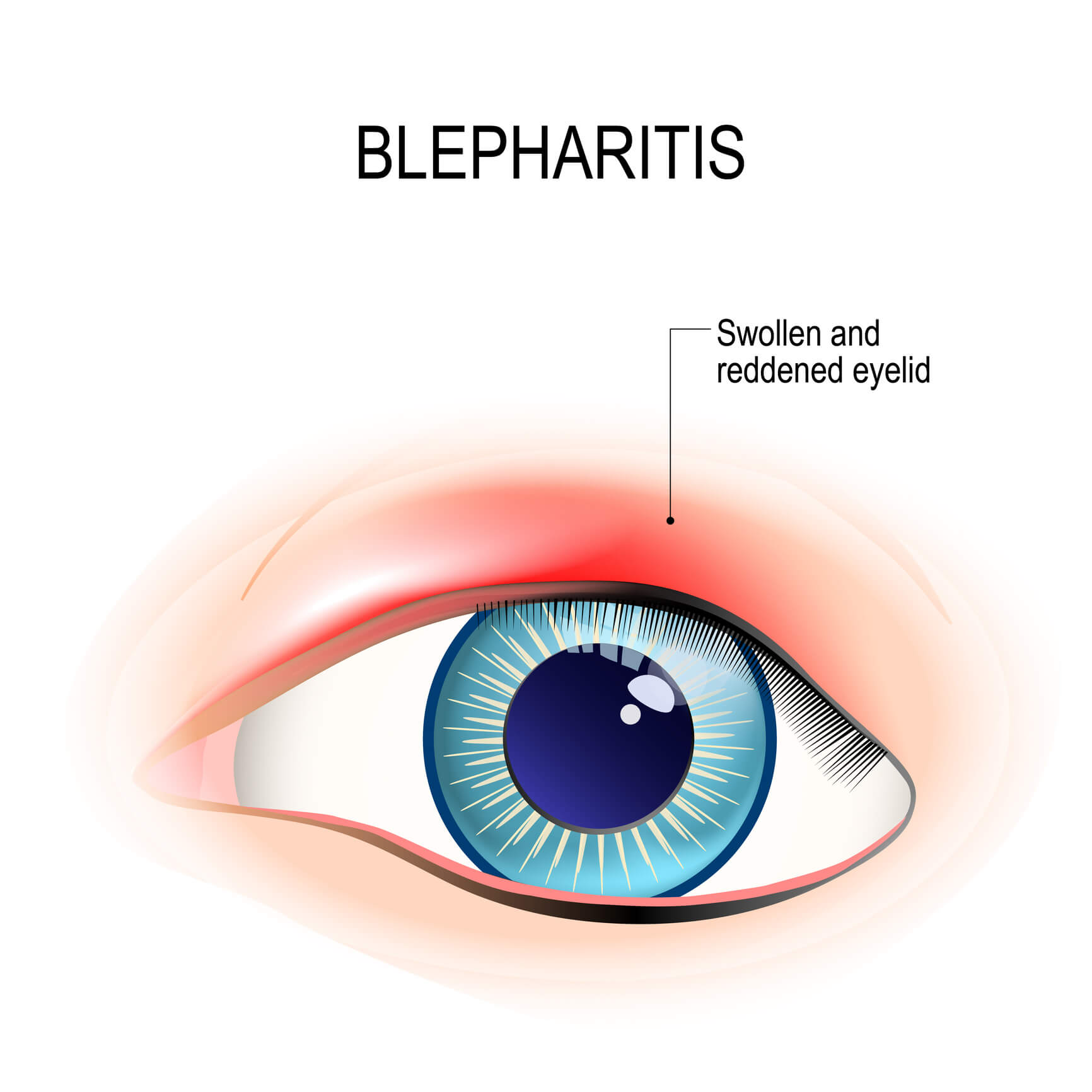 What is Blepharitis? - Lehigh Eye Specialists